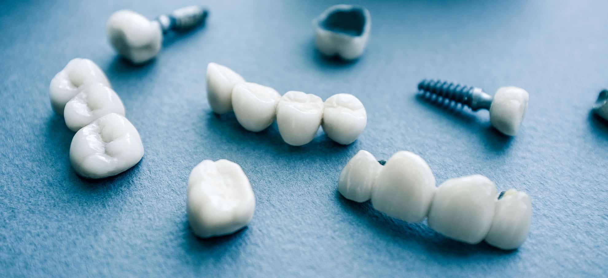 The Fundamentals of Tooth Replacement - Gateway Oaks Dental
